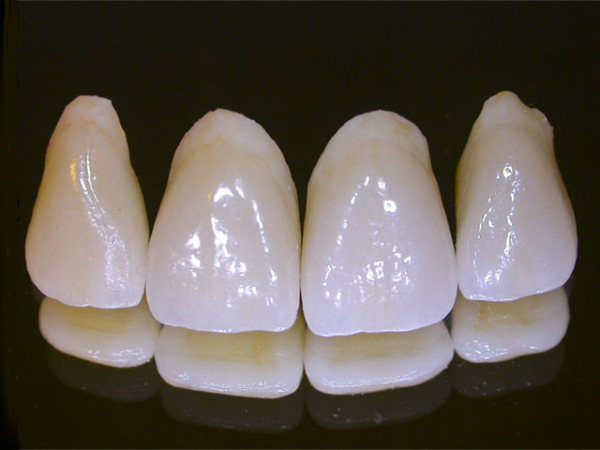 Porcelain_Dental_Crowns - Monroe Family Dentistry