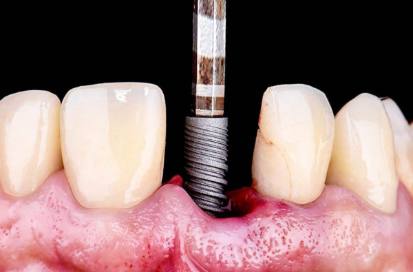 Benefits Of Dental Implants For Elderly Patients | Monroe Family Dentistry