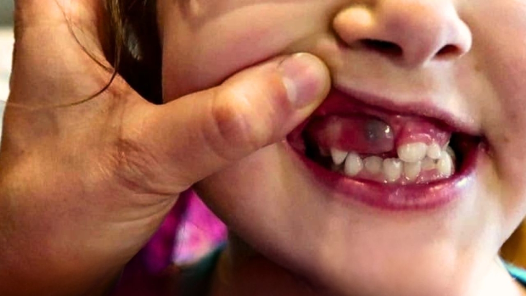 Eruption Cysts & Dental Health | Monroe Family Dentistry