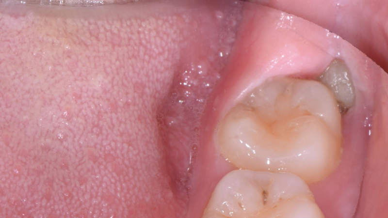 Wisdom Teeth, Sore Gums & Symptoms Of An Infected Tooth Explained